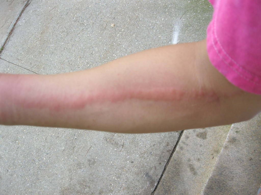 リンパ管炎とは？症状や原因は？治療には薬が有効？慢性の場合と急性の場合、それぞれを紹介！ | Hapila [ハピラ]