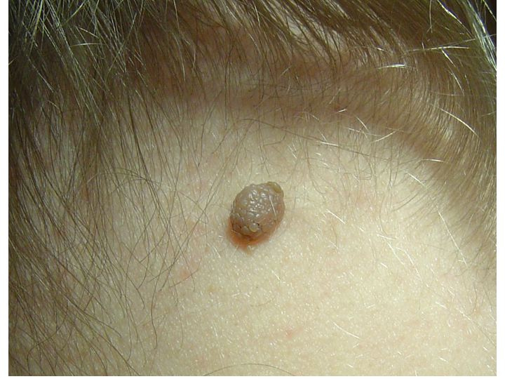 ウンナ母斑とは？原因や治療法を知ろう！その他の母斑についても紹介！ | Hapila [ハピラ]